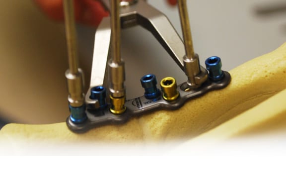 Four Corner Fusion - Joint Replacement
